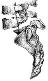 Lumbalgia