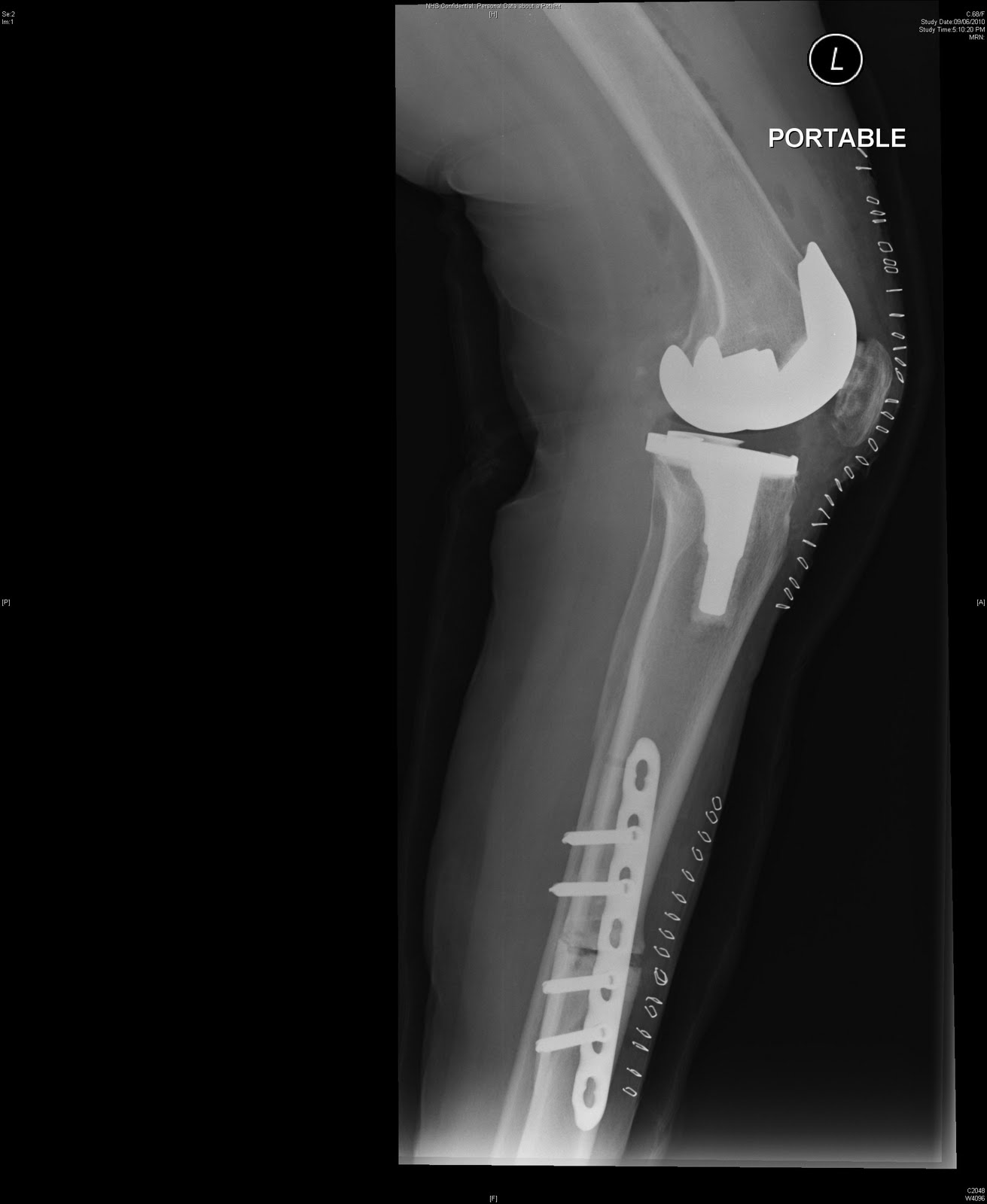 Joint Preservation and Replacement : Tibia Vara Causing OA knee
