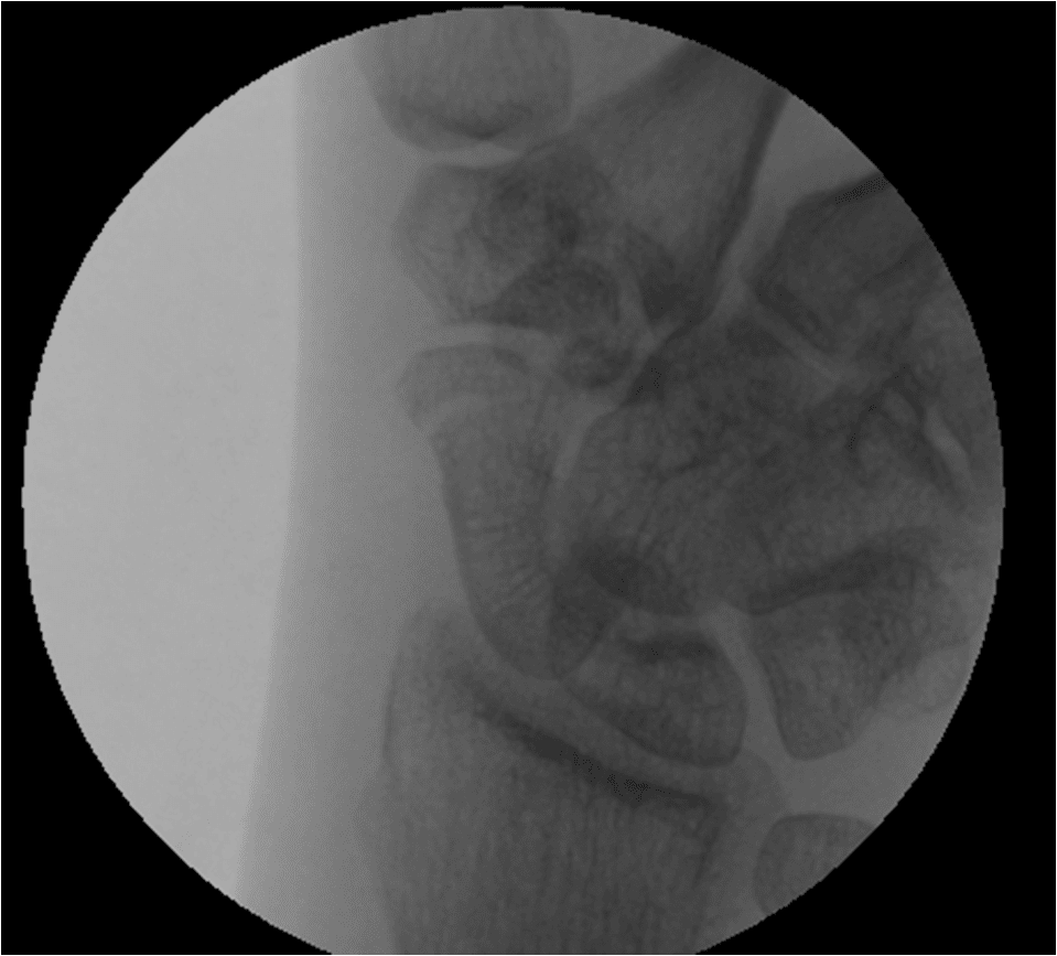 Joint Preservation and Replacement : Distal pole scaphoid fracture with ...