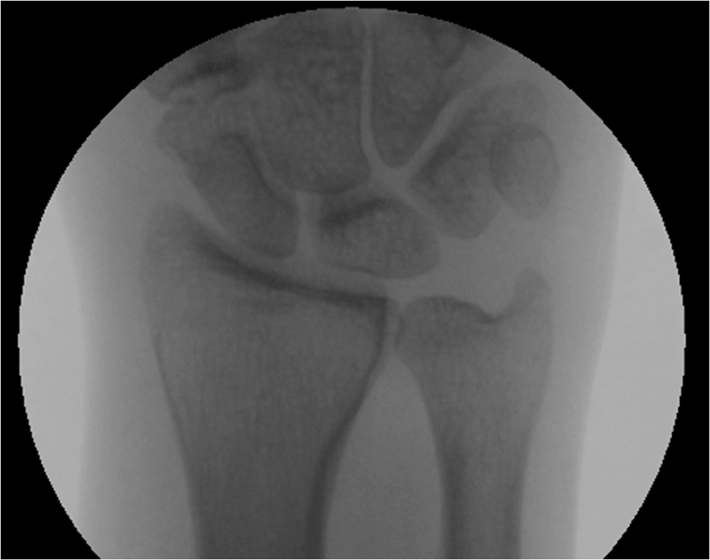 Joint Preservation and Replacement : Distal pole scaphoid fracture with ...