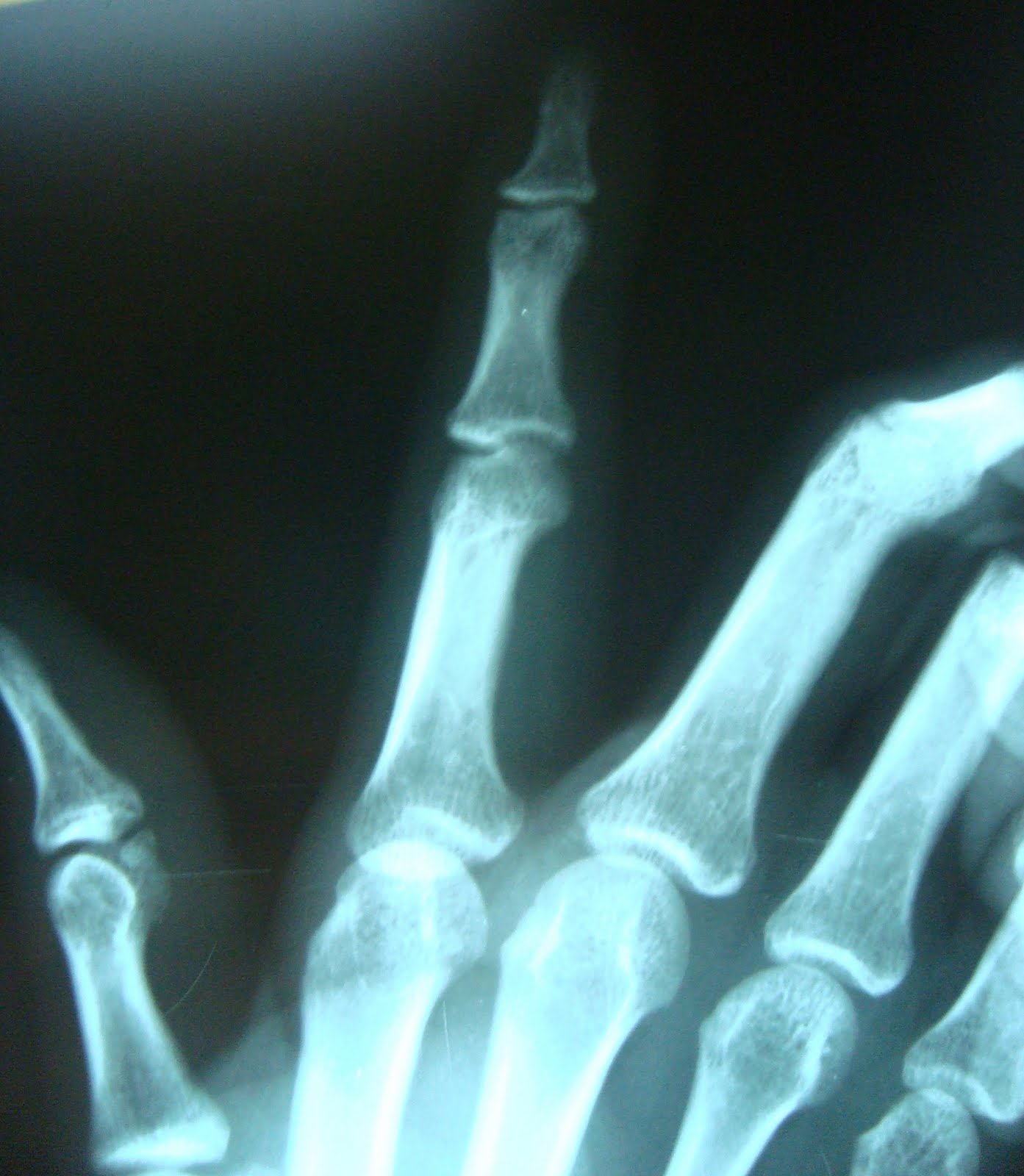 Rayos 2011: Dedos (Segundo a Quinto)