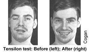 The Power of Giving: What is Tensillon Test???