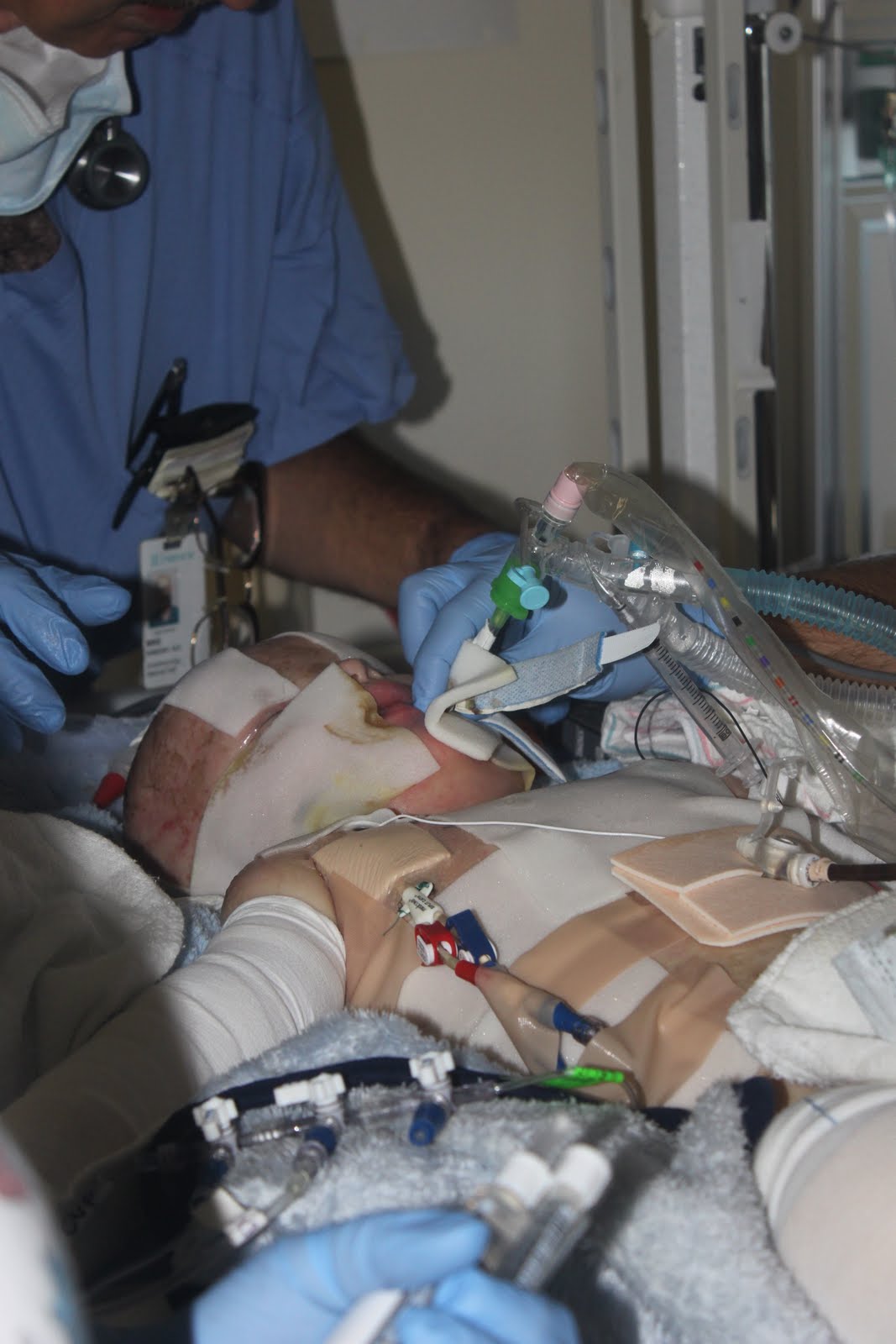 Baby Daylon: Day +46: EXTUBATION DAY!!
