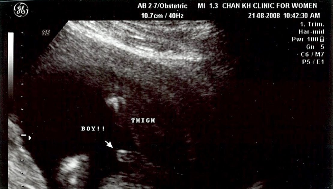 The Bub in the Belly: Scan at 17 weeks - Gender announcement and ...