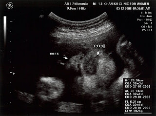 The Bub in the Belly: Scan at 32 weeks