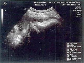 The Bub in the Belly: Scan at 39 weeks