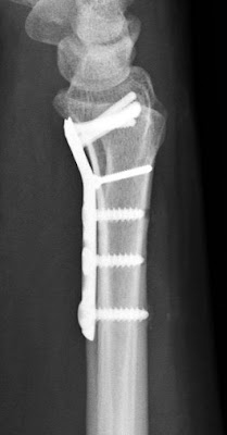 Walks with Moss: dvr plate pictures of my bionic wrist