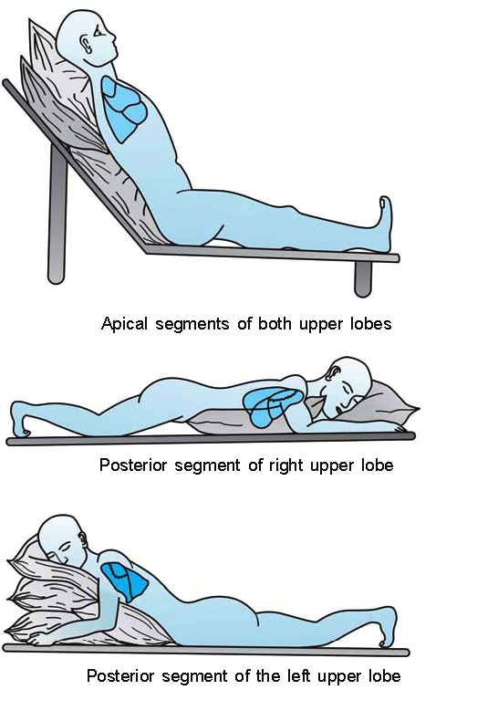 Physioteach: POSTURAL DRAINAGE POSTIONS