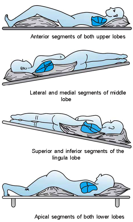 Drainage, Postural; Postural Drainage; Postural Drainage, Pulmonary ...