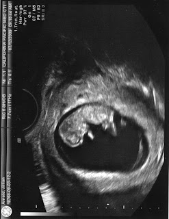 Little Arnold: 10 Week Ultrasound