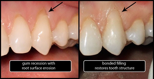 Floss n' Blog: Bonding...cervical abrasion