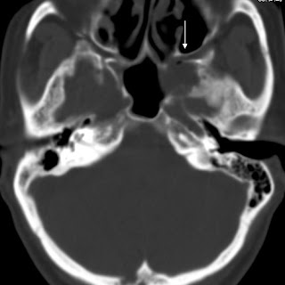 Nontraumatic Skull Base Defect with CSF Rhinorrhea - Sumer's Radiology Blog