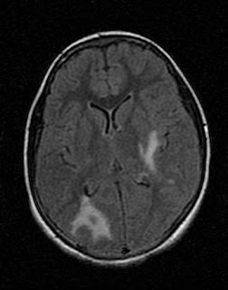 Acute disseminated encephalomyelitis-MRI - Sumer's Radiology Blog