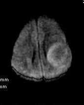 Acute disseminated encephalomyelitis-MRI - Sumer's Radiology Blog