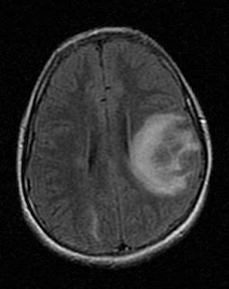 Acute disseminated encephalomyelitis-MRI - Sumer's Radiology Blog