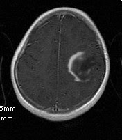 Acute disseminated encephalomyelitis-MRI - Sumer's Radiology Blog