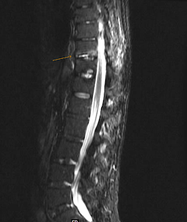 Andersson lesion-Ankylosing Spondylitis - Sumer's Radiology Blog