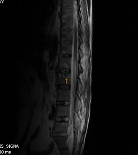 ANKYLOSING SPONDYLITIS-MRI - Sumer's Radiology Blog