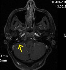 Glomus Tympaniucm-MRI &CT - Sumer's Radiology Blog