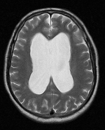 Normal Pressure Hydrocephalus-MRI - Sumer's Radiology Blog