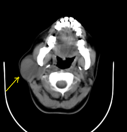 First Branchial Cleft Cyst-CT - Sumer's Radiology Blog