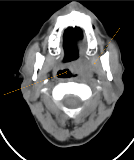 Carcinoma Tonsil-CT - Sumer's Radiology Blog