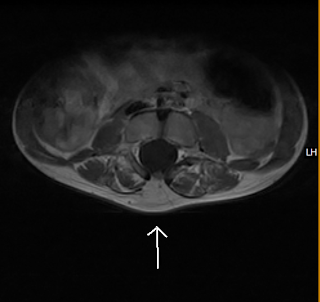 Lipomyelomeningocele-MRI - Sumer's Radiology Blog