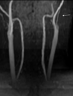 Post traumatic Internal carotid dissection-MRA - Sumer's Radiology Blog