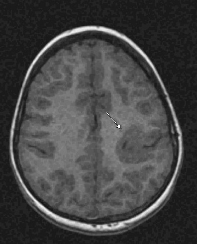 Cortical Dysplasia-MRI - Sumer's Radiology Blog