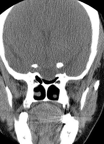Empty Sella and CSF Rhinorrhea-MRI & CT - Sumer's Radiology Blog
