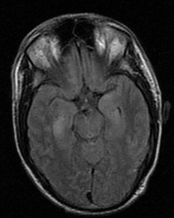 Diffuse Axonal Injury-MRI - Sumer's Radiology Blog