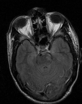 Diffuse Axonal Injury-MRI - Sumer's Radiology Blog