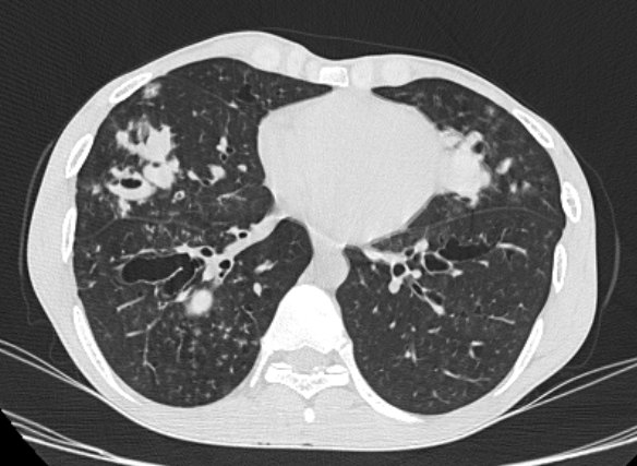 Allergic Bronchopulmonary Aspergillosis-HRCT - Sumer's Radiology Blog