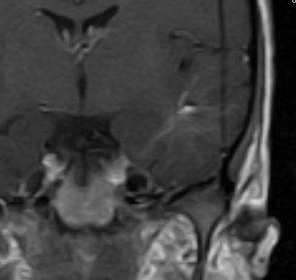 Venous Angioma-MRI - Sumer's Radiology Blog