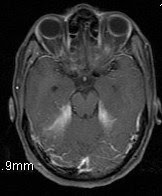 Hypertrophic cranial pachymeningitis-MRI - Sumer's Radiology Blog