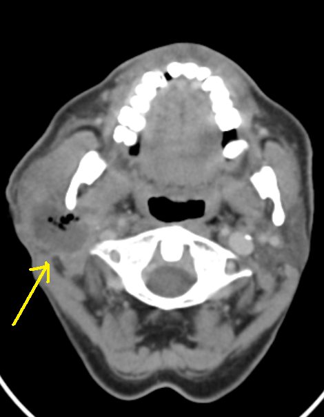 Parotid Abscess - Sumer's Radiology Blog