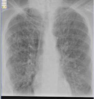Pulmonary Fibrosis- CXR - Sumer's Radiology Blog