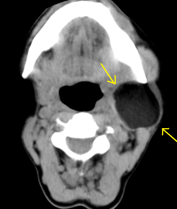 Parotid Lipoma-CT - Sumer's Radiology Blog