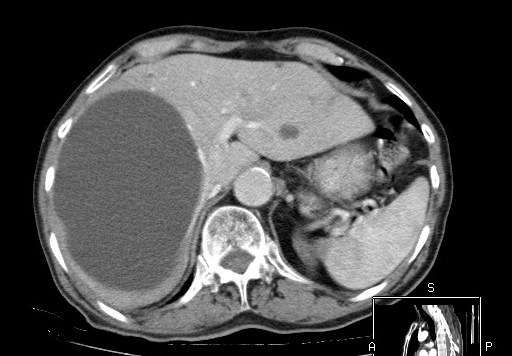 Air Mensicus Sign in Hydatid Disease - Sumer's Radiology Blog