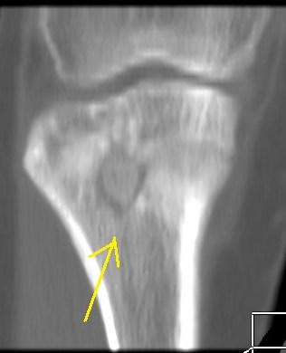 Brodie's Abscess-CT - Sumer's Radiology Blog