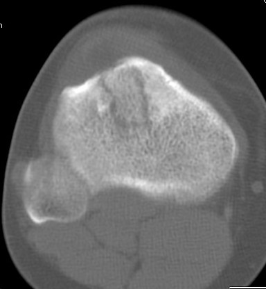 Brodie's Abscess-CT - Sumer's Radiology Blog