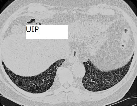 Interstitial Lung Disease Series-Part 1- Usual Interstitial pneumonia ...