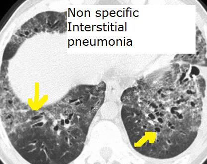Interstitial Lung Disease Series-Part 2- Non specific Interstitial ...