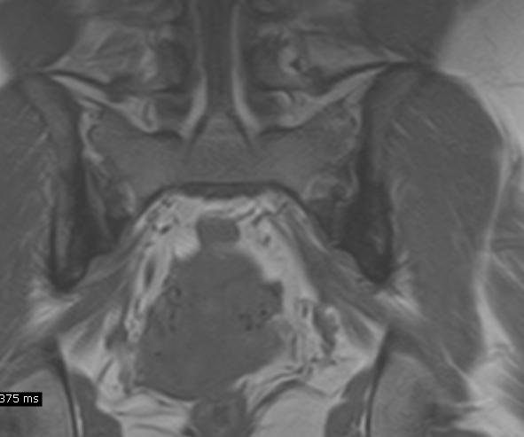 Osteitis Condensans ilii-MRI - Sumer's Radiology Blog