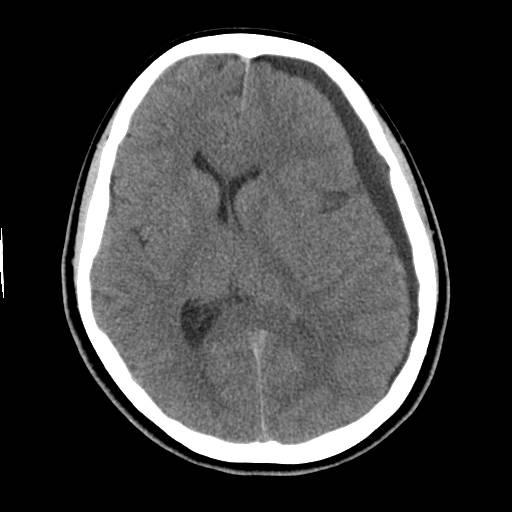 Post Traumatic Rupture of Arachnoid Cyst-CT - Sumer's Radiology Blog