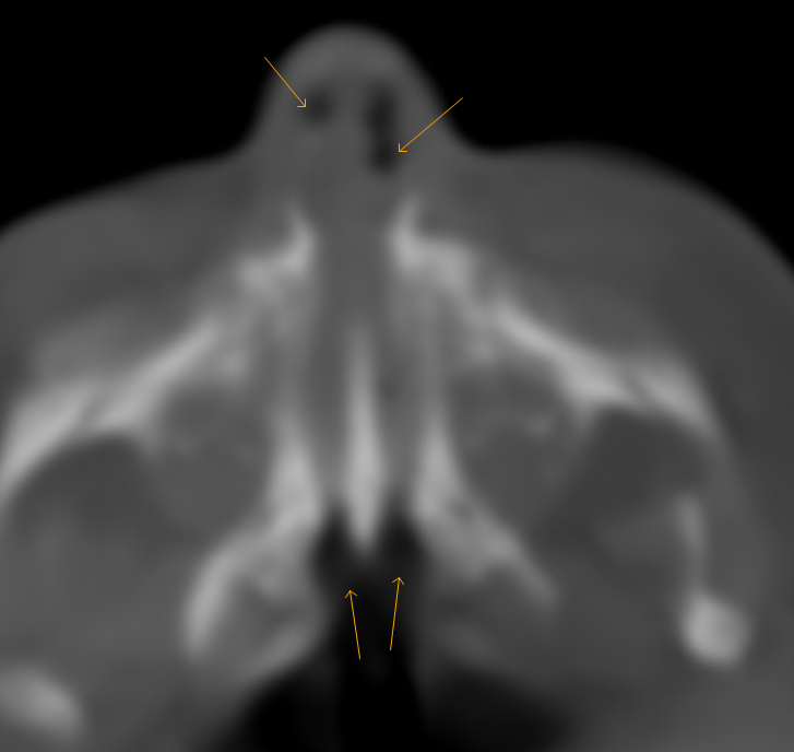 Choanal Atresia-CT - Sumer's Radiology Blog