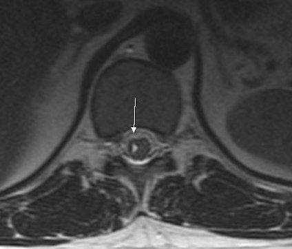 Post Spinal Anesthesia Syrinx-MRI - Sumer's Radiology Blog