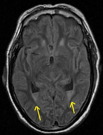 Ventriculitis- Diffusion weighted MRI - Sumer's Radiology Blog