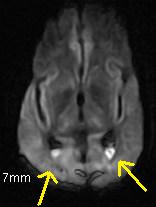 Ventriculitis- Diffusion weighted MRI - Sumer's Radiology Blog