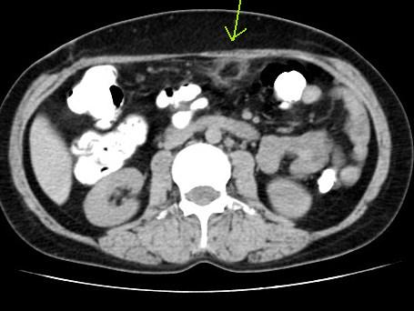 Omental Fat Necrosis - Sumer's Radiology Blog